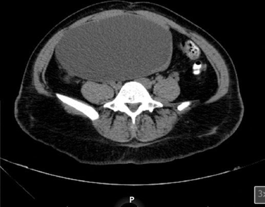 Quiste paratubárico gigante: reporte de un caso en un hospital público ...