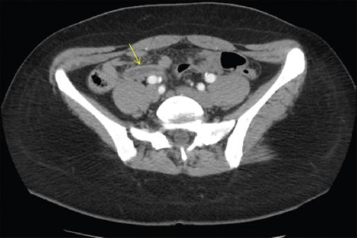Peritoneal sarcoidosis that simulates peritoneal carcinomatosis: a case ...