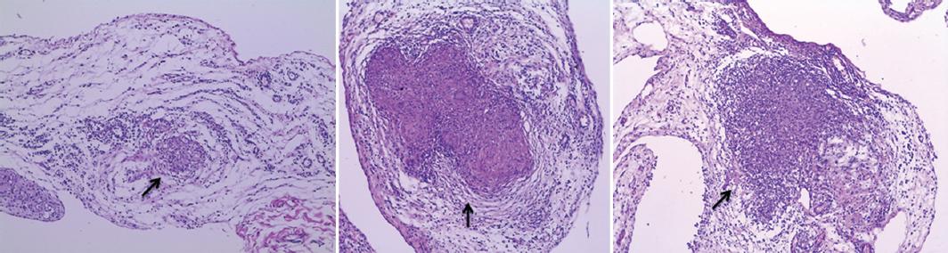 Peritoneal sarcoidosis that simulates peritoneal carcinomatosis: a case ...