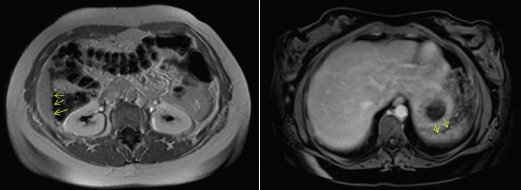 Peritoneal sarcoidosis that simulates peritoneal carcinomatosis: a case ...