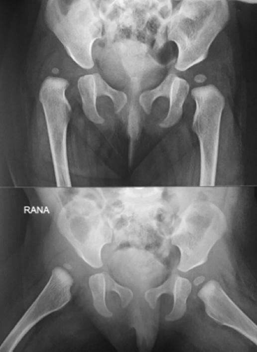 Detección radiográfica oportuna de displasia del desarrollo de la ...