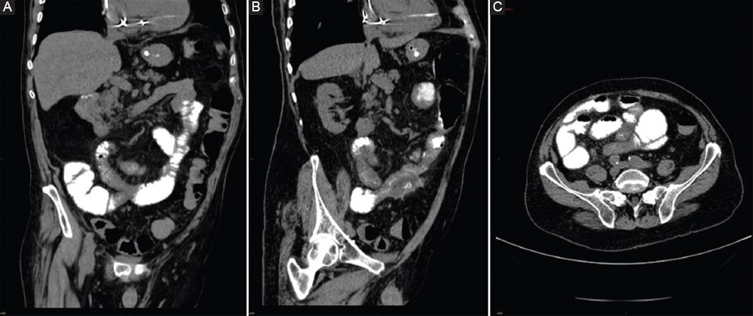 Eosinophilic enteritis presenting as intestinal obstruction: case ...