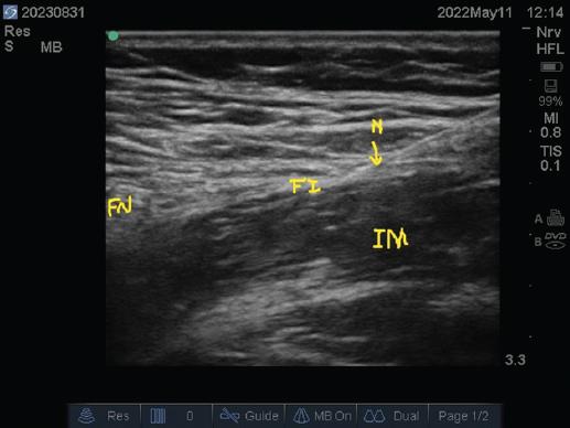 Application of hip capsule peripheral nerve block in early analgesia in ...