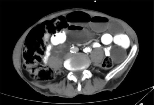 Determining the need for surgery in small bowel obstructions based on ...