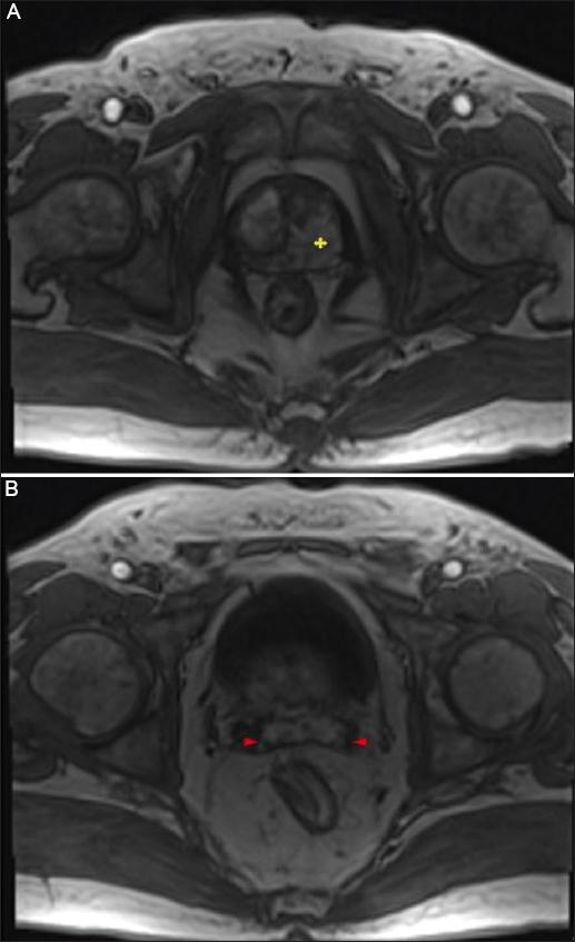 Role of contrast agent in evaluation of periprostatic invasion in ...
