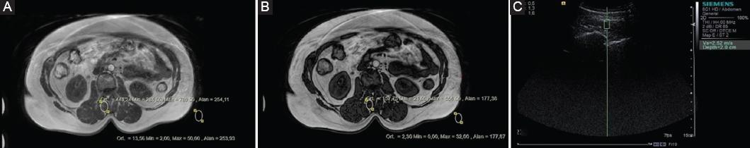 Comparison of US elastography and chemical shift magnetic resonance ...