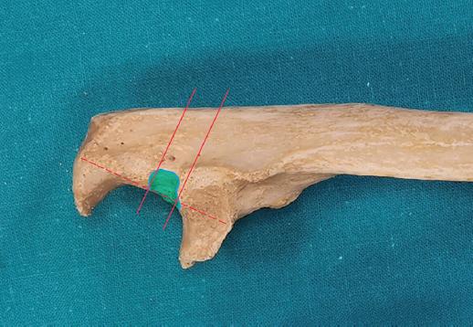 Morphology of ulnar trochlear notch and defining ideal position for ...