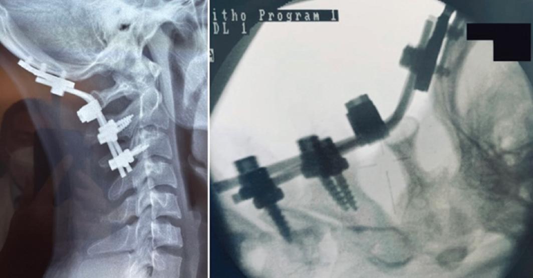 Report of two cases of high cervical injury: an adequate functional ...