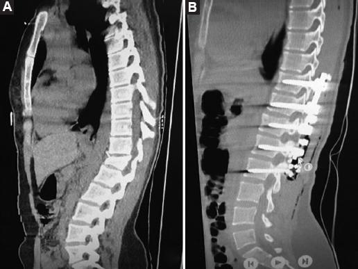 Comparison posterior lumbar stabilization with dynamic rod system and ...