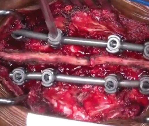 Comparison posterior lumbar stabilization with dynamic rod system and ...