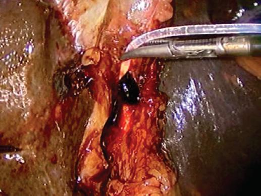 Identificación anatómica de la vía biliar por iluminación intrínseca en ...