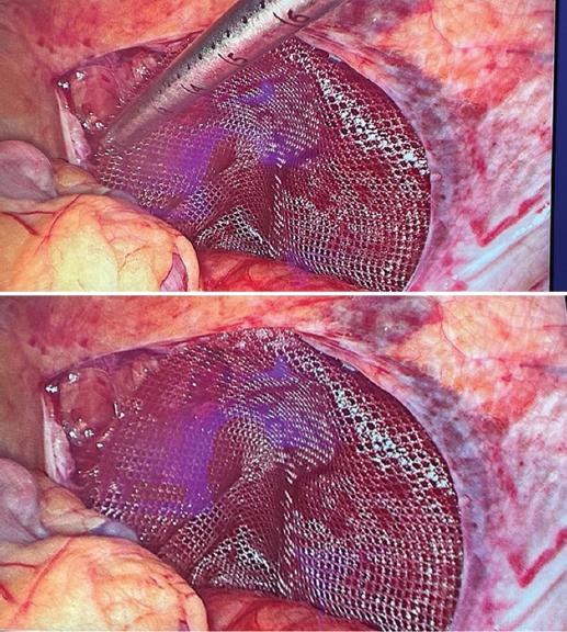 Reparación laparoscópica de hernia ilíaca tras la obtención de injerto ...