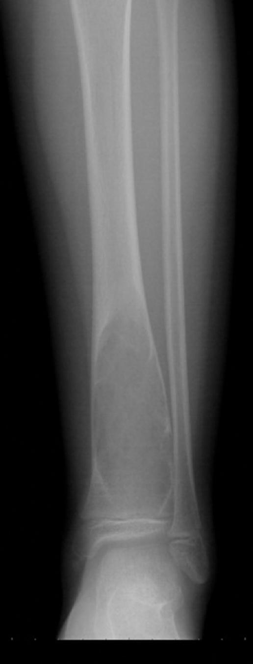 Decreased plasma visfatin concentrations in pediatric aneurysmal bone ...