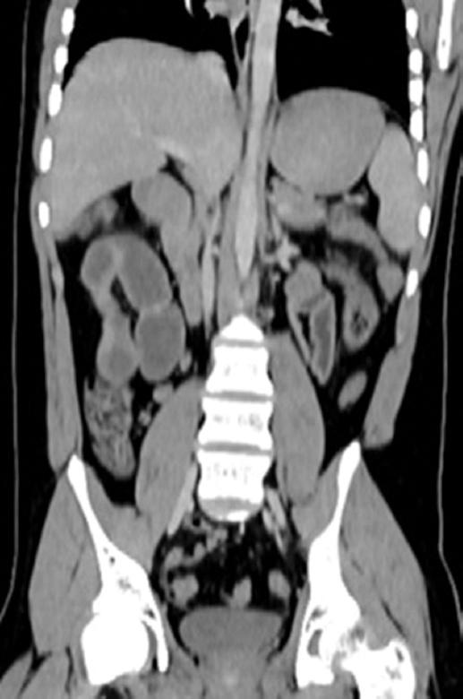 A rare cause of intestinal obstruction: sock ingestion