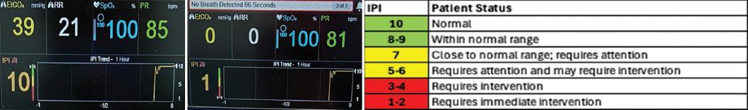 Respiratory monitoring during endoscopic procedures: efficacy and ...