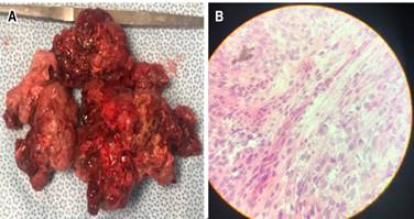 Leiomyosarcoma: an unusual cardiac tumor. Case report and literature review