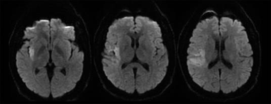 Non-hyperacute synchronous cardio-cerebral infarction treated by double ...