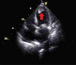Non-hyperacute synchronous cardio-cerebral infarction treated by double ...