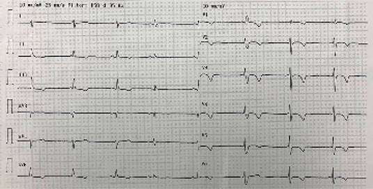 Electrocardiographic abnormalities in subarachnoid hemorrhage