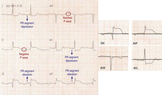 Atrial infarction: a literature review