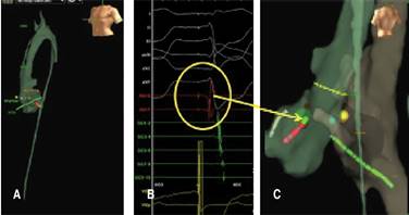 Radiofrequency catheter ablation of cardiac arrhythmias using only ...