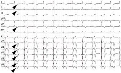 Wellens’ syndrome: report and review of a case
