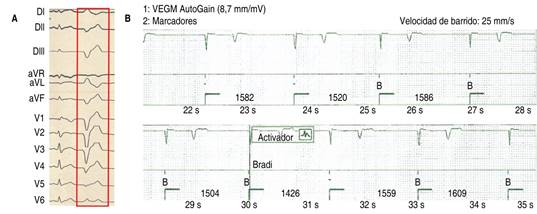 Pre-syncope and ablation of moderator band premature ventricular ...