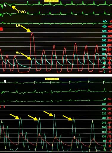 Hypertrophic obstructive cardiomyopathy in an octogenarian patient