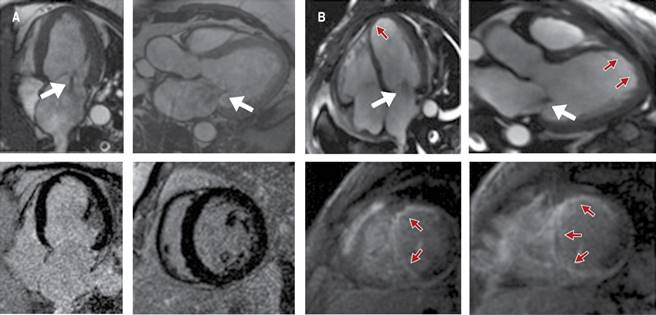 The emerging added value of cardiac magnetic resonance over ...
