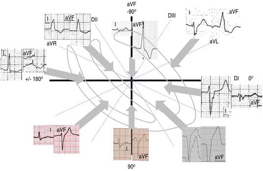 Deductive analysis of the electrocardiogram to determine the site of ...