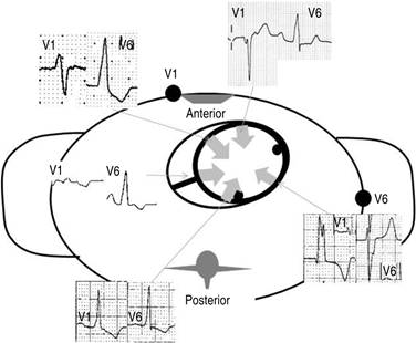 Deductive analysis of the electrocardiogram to determine the site of ...