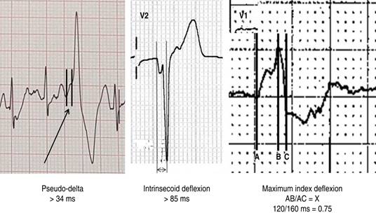 Deductive analysis of the electrocardiogram to determine the site of ...