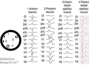 Deductive analysis of the electrocardiogram to determine the site of ...
