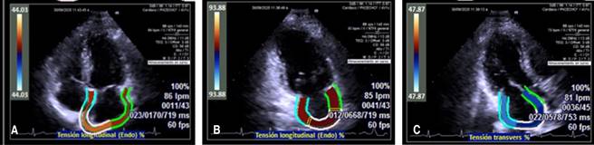 Triplane left atrial strain
