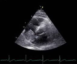 Right atrial heart myxoma, two different presentations of the same ...