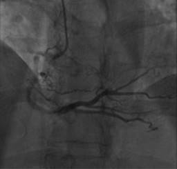 Right atrial heart myxoma, two different presentations of the same ...