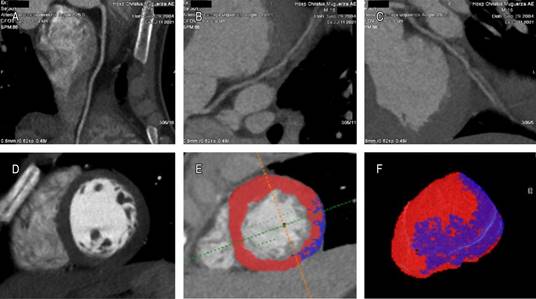 Acute myocarditis after administering the BNT162b2 (Pfizer-BioNTech ...