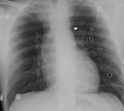 Coarctation of the aorta associated with bicuspid aortic valve ...