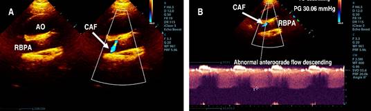 Coronary artery to right pulmonary artery fistula in an adolescent