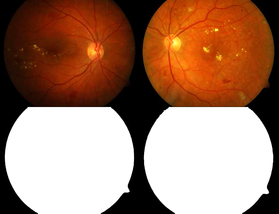 Exudates and Blood Vessel Segmentation in Eye Fundus Images Using the ...