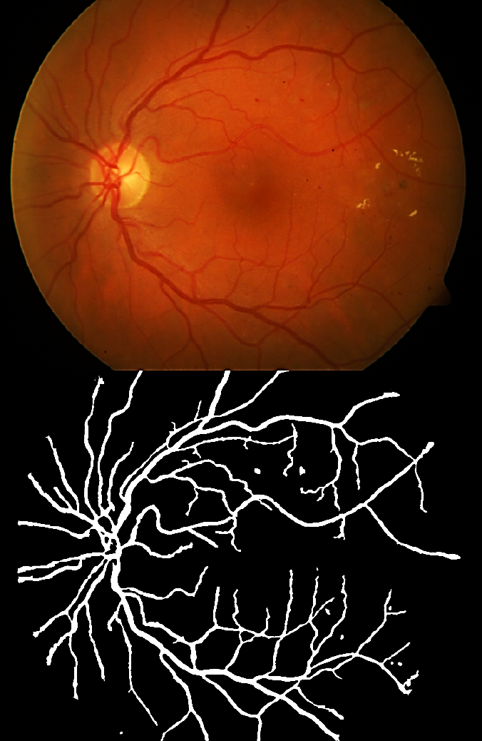 Exudates and Blood Vessel Segmentation in Eye Fundus Images Using the ...