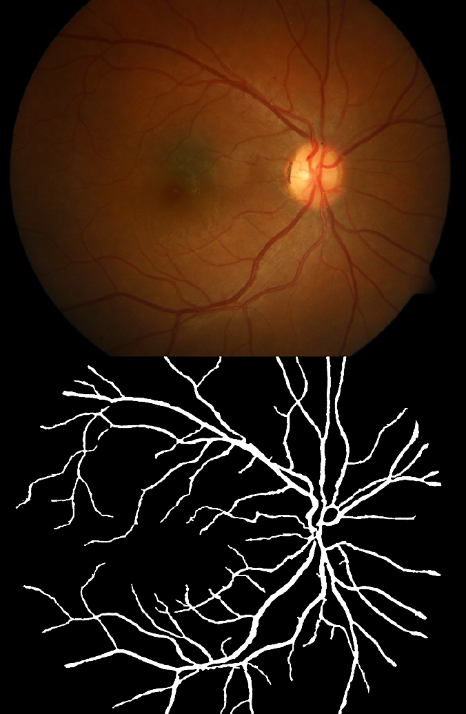 Exudates and Blood Vessel Segmentation in Eye Fundus Images Using the ...