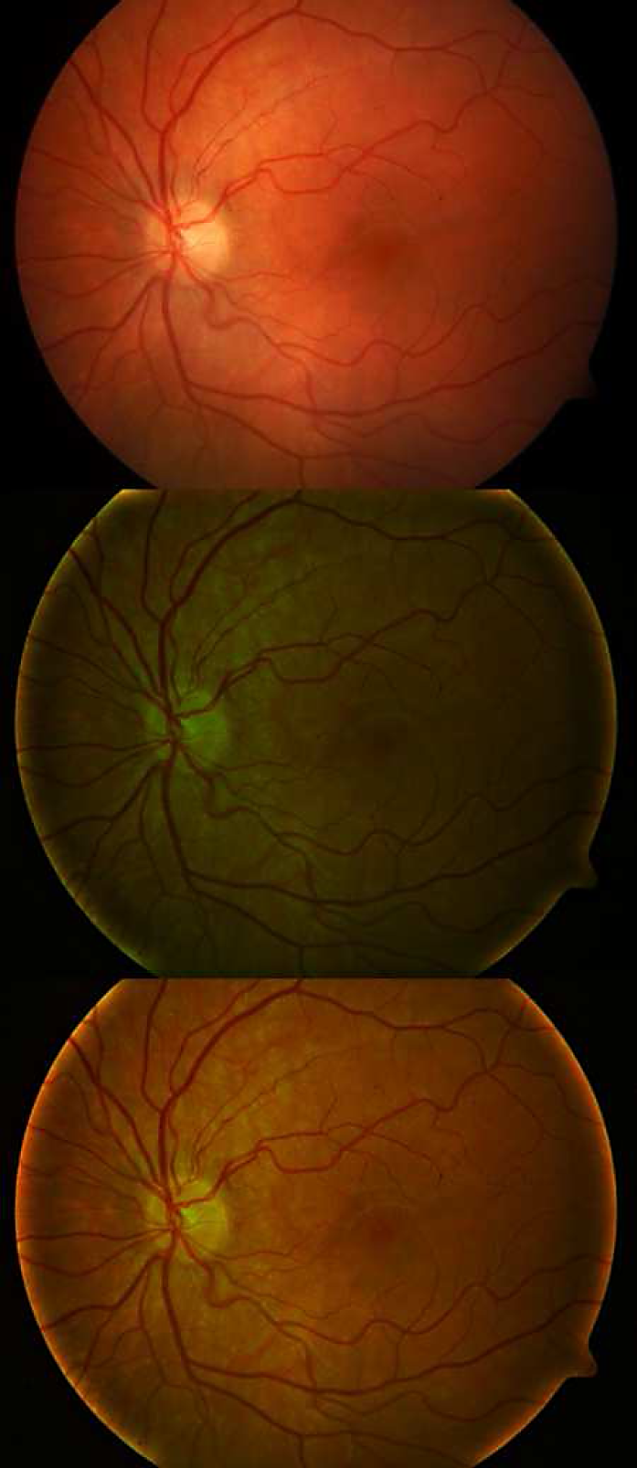 Exudates and Blood Vessel Segmentation in Eye Fundus Images Using the ...