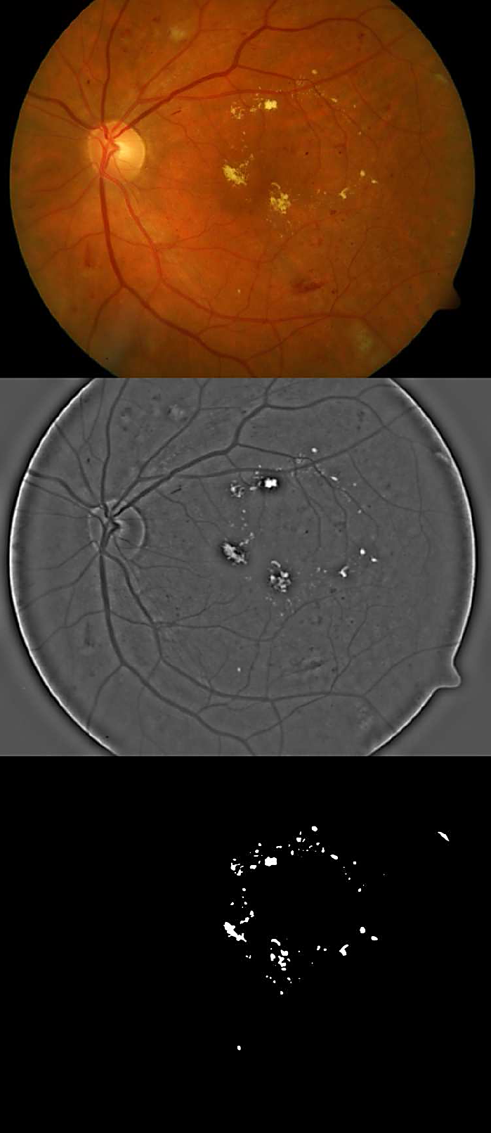 Exudates and Blood Vessel Segmentation in Eye Fundus Images Using the ...