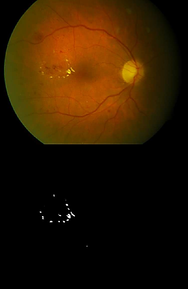 Exudates and Blood Vessel Segmentation in Eye Fundus Images Using the ...