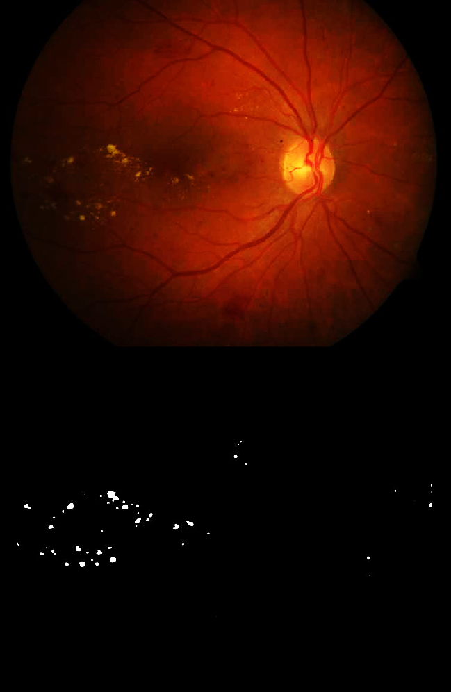 Exudates and Blood Vessel Segmentation in Eye Fundus Images Using the ...