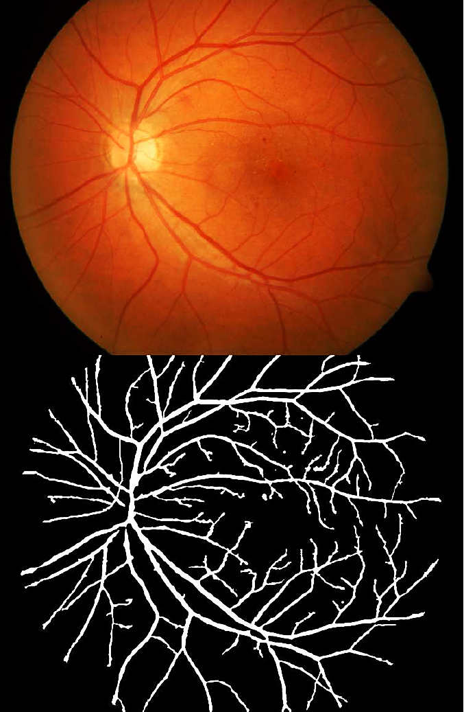Exudates and Blood Vessel Segmentation in Eye Fundus Images Using the ...