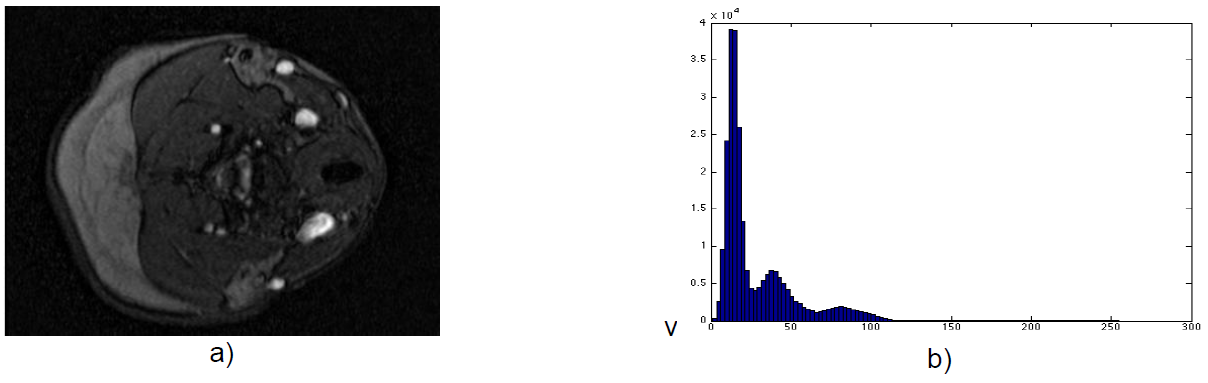 Processing of MRI Images Weighted in TOF for Blood Vessels Analysis: 3 ...