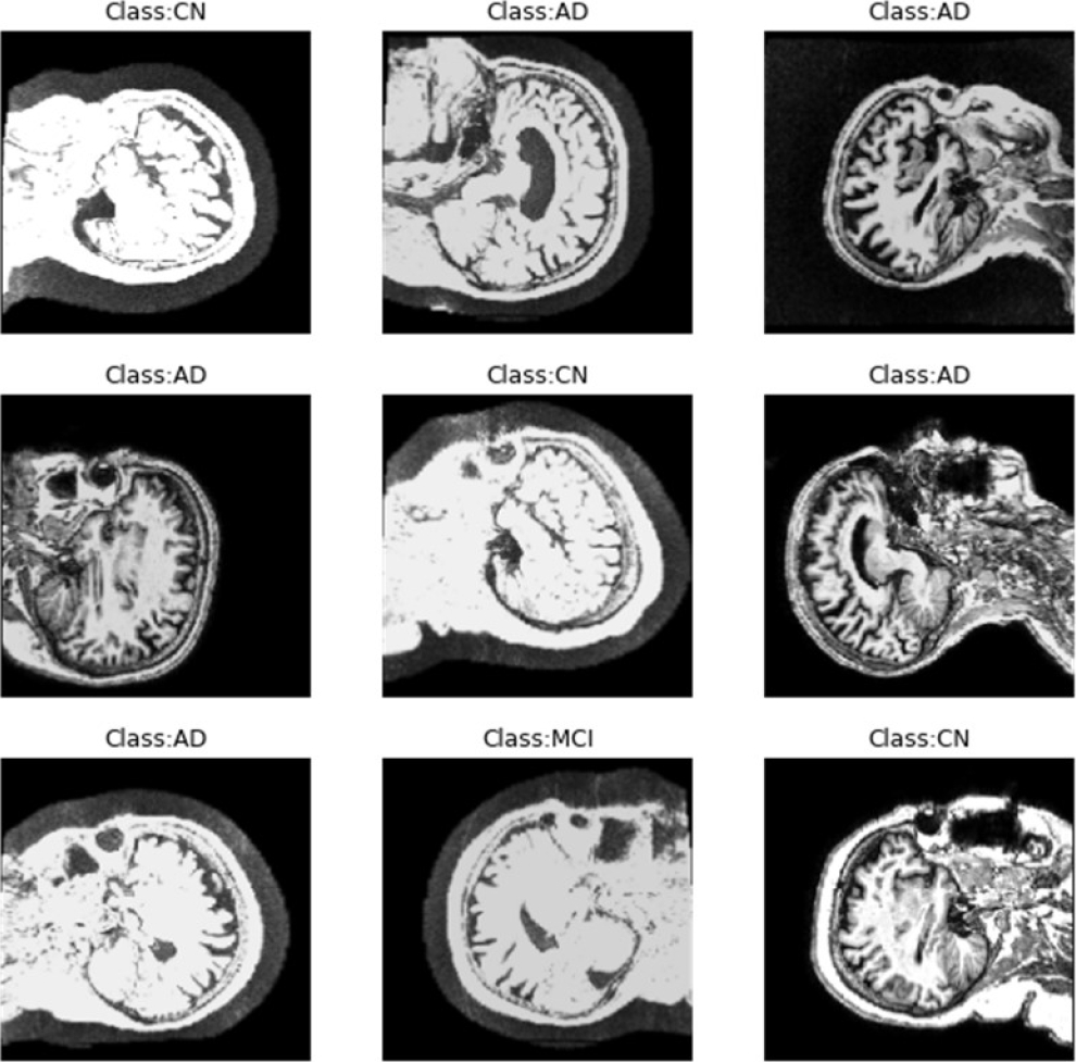 Big Medical Image Analysis: Alzheimer’s Disease Classification Using Convolutional Autoencoder