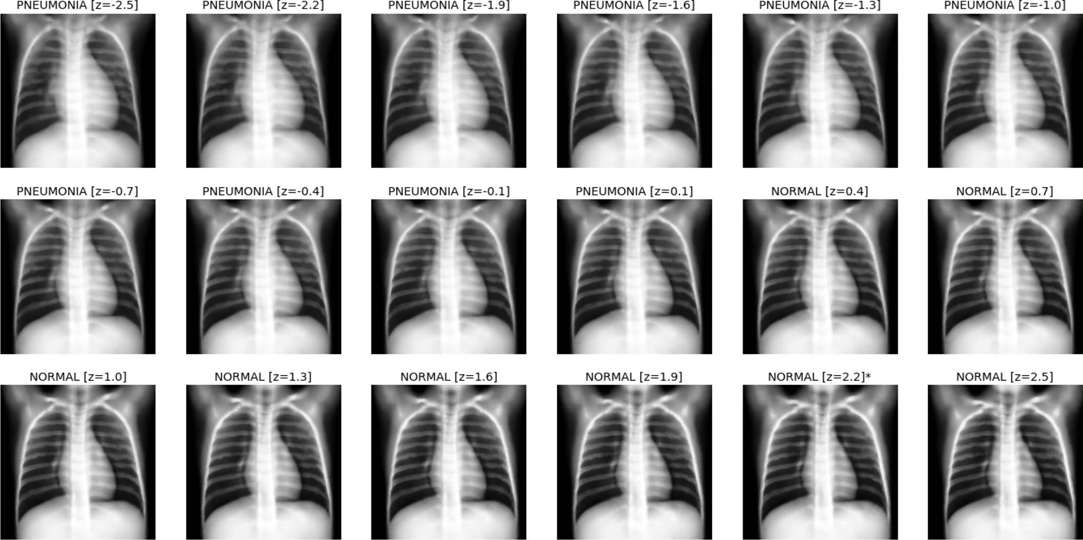 Normal Chest X Ray Vs Pneumonia